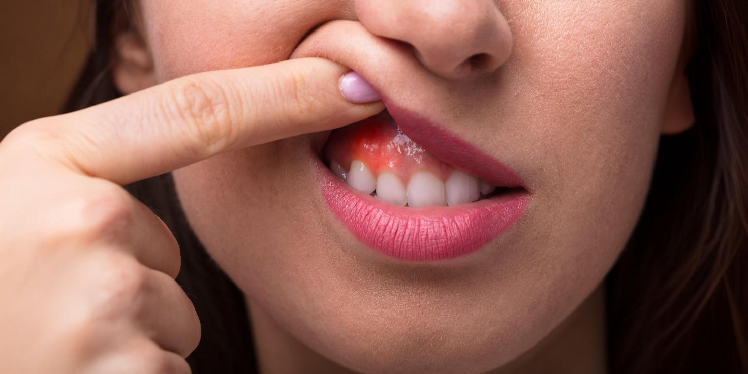Bleeding Gums? Signs of Gum Disease & How to Prevent It – Vernam Iconic